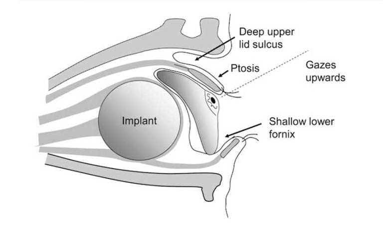 Socket Surgery for Prosthetic Eyes | NZ Eye Reconstruction